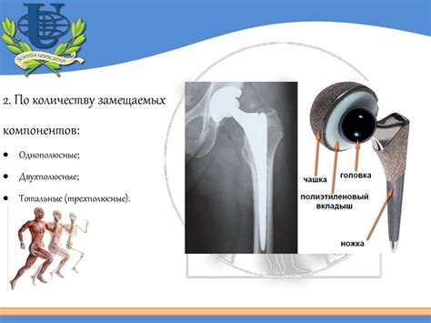 Эндопротезирование тазобедренного сустава ЭТБС Online Presentation