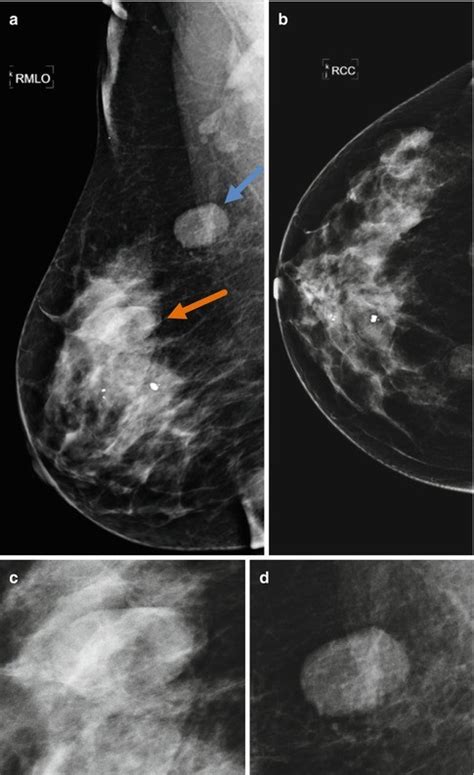 Fibroadenoma Springerlink
