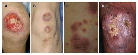 Pyoderma Gangrenosum An Important Dermatologic Condition Occasionally Associated With Rheumatic