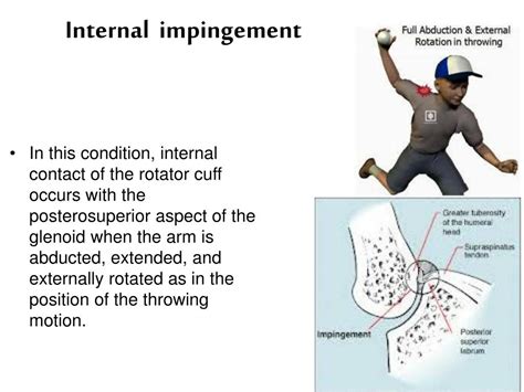 Ppt Impingement Syndrome Powerpoint Presentation Free Download Id 5436216