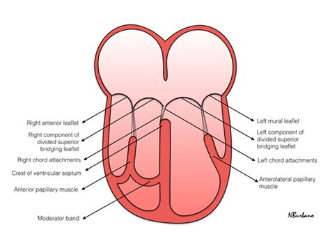 Transitional Av Canal Defect