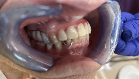Case Study Restoring The Anterior Zone With Maxillary Partials Dandy