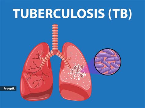 Can You Get Tuberculosis From Kissing A Doctor Explains The Risks