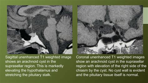 Pituitary Gland Mri Pptx