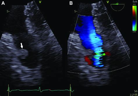 Two Dimensional Tee Deep Transgastric Rv Outflow 0 View Without A
