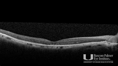 Course Ruptured Macroaneurysm With Sub Macula Hemorrhage Treated With Tpa And Pneumatic