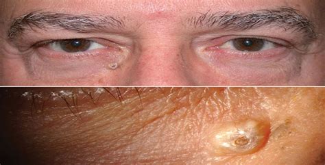 Unusual Location For A Periorbital Dermoid Cyst Ophthalmic Plastic