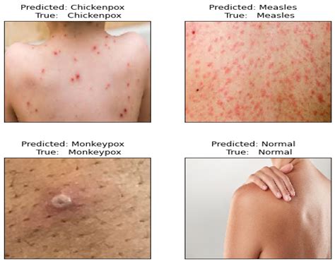 Tms Ensemble Deep Learning Model For Accurate Classification Of
