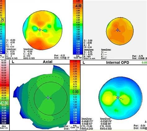 Preoperative Scans Showing Refraction With Cycloplegia Top Left And Download Scientific