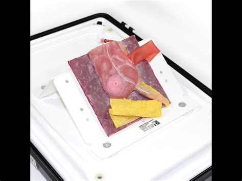 Vermiform Appendix Normal Anatomy Limbs And Things Us