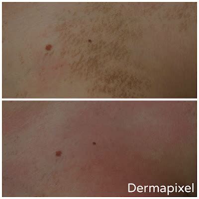 Dermapixel Dermatosis Neglecta El Algodón No Engaña