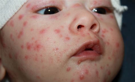 Herpes Tipo 6 En Niños Qué Tipo De Virus Síntomas Y Tratamiento
