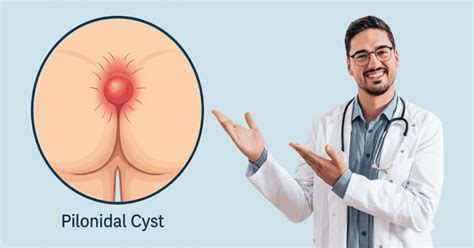 Untreated Pilonidal Cyst What You Risk By Not Seeking Treatment