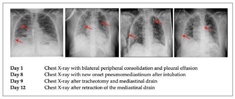 Chest X Ray Images Showing The Patient Before During And After