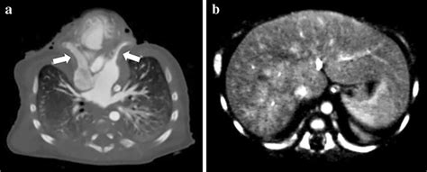 Patient 6 Ct Angiography In A 3 Day Old Boy With Thoracic Ectopia