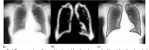 Figure From Segmentation Of Lung Fields In Digital Chest Radiographs By Artificial Neural