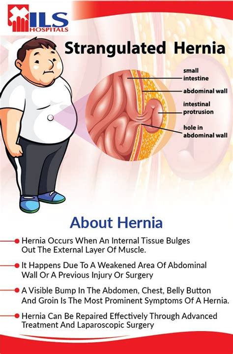 Inguinal Hernia Signs And Symptoms Types Causes Risk Factors Artofit