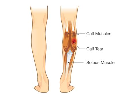 Plantaris Tendon Rupture Tendon Dachille Plantaire Pmtnw