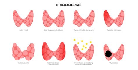 Goiter Hypothyroidism