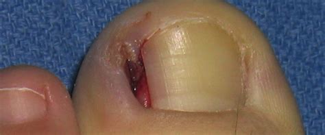 Nail Avulsion With Matrixectomy Treatment Understanding Toenail Fungus Solutions