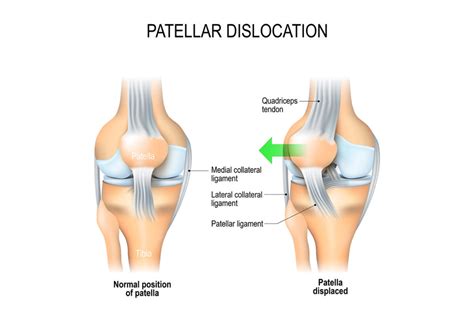 Recurrent Patellar Dislocation