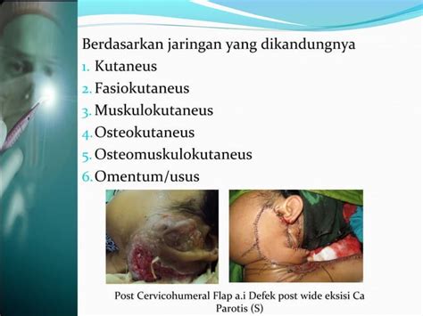 Case Report Tibial Defect Post Orif Ppt