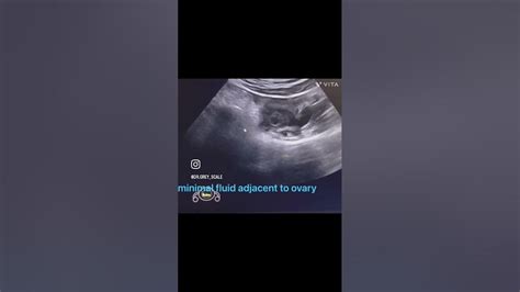 Ectopic Prefnancy Youtube