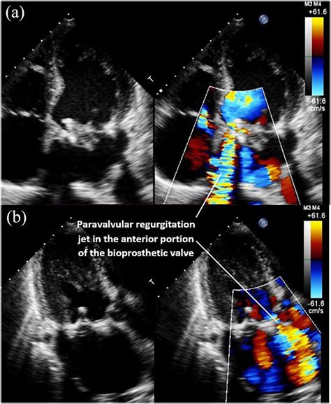 Transthoracic Echocardiography In A Apical Fourchamber And B Apical Download Scientific