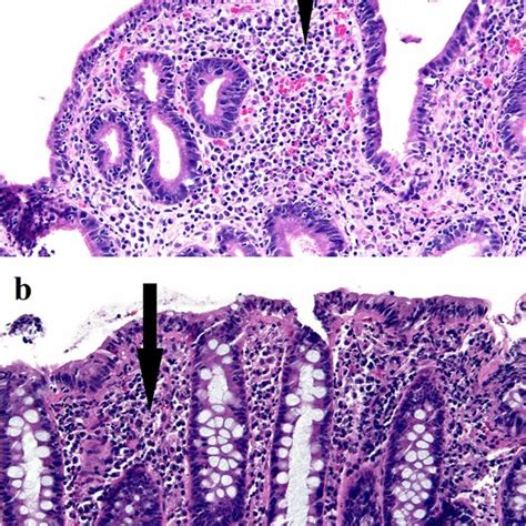 Duodenum And Colon Biopsies From A Patient With Ipex Like Syndrome And