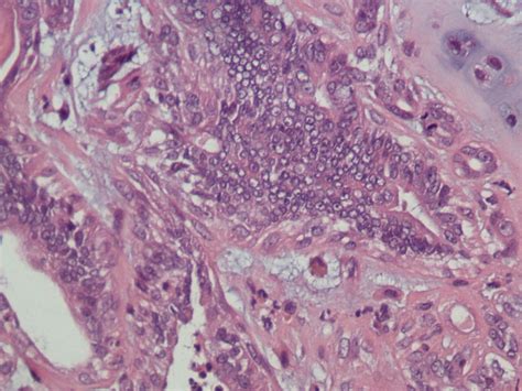 Canine Mammary Gland Malignant Mixed Mammary Tumor Carcinosarcoma