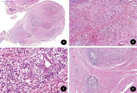 Histopathological Examination A Lesion With A Multi Nodular