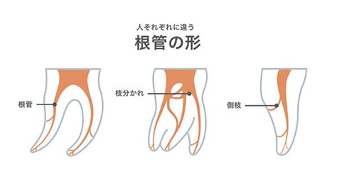 【用語解説】根管治療とは｜精密根管治療専門の岡野歯科医院