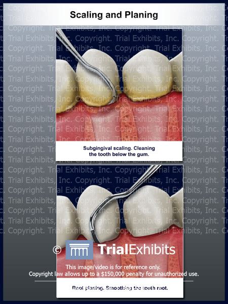 Subgingival Scaling And Root Planing Trial Exhibits Inc