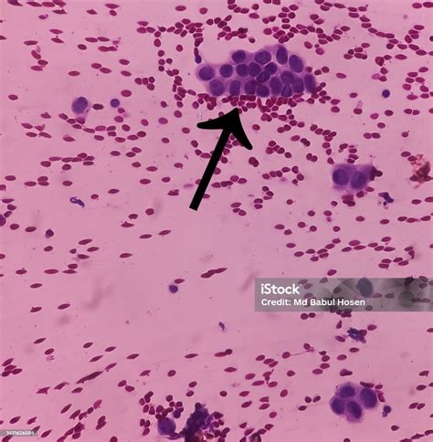 겨드랑이 림프절 양성 악성 세포 전이성 덕트 암종 얼룩은 비정형 덕트 상피 세포의 세포 물질을 보여 주며 배경은 염증 세포 혈액을 보여줍니다 건강관리와 의술에 대한 스톡