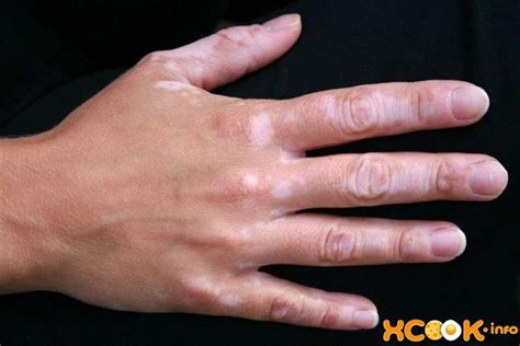 Белые пятна на руках причины появления и способы лечения