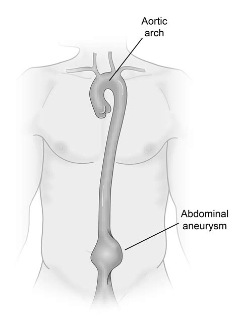 Abdominal And Thoracic Aortic Aneurysm Surgery Treatments Patients And Families Uw Health