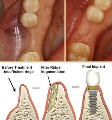 What To Expect After Dental Bone Graft Dental News Network