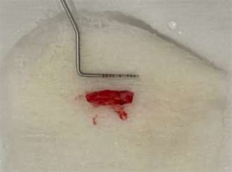 Subepithelial Connective Tissue Graft Download Scientific Diagram