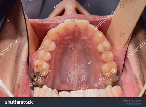 Maxillary Arch Occlusal View Anatomy