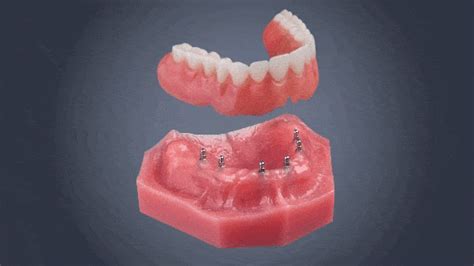Denture Replacement In Ontario Ca Mini Implant Implant Bridge