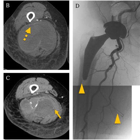Arterial Supply To The Left Lower Extremity A Sciatic Artery Forming