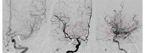 Illustration Of Moyamoya Vessels Concentration A Mild Stenosis Of M1 Download Scientific