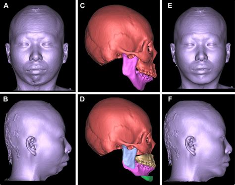 Genioplasty In Contemporary Orthognathic Surgery Oral And
