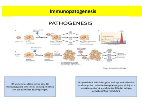 Immune Reconstitution Inflammatory Syndrome Iris Ppt