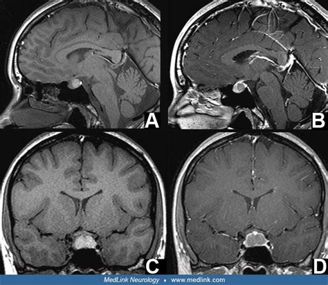 Pituitary Tumor Mri