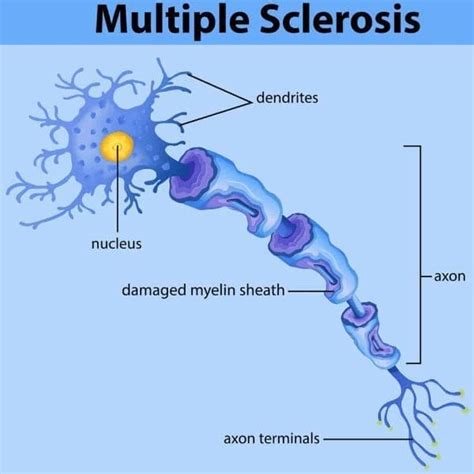 What Is Multiple Sclerosis Dubai Mobility