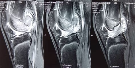 Mri Showing Partial Exophytic Cortical Subcortical Lesion Along The Download Scientific Diagram