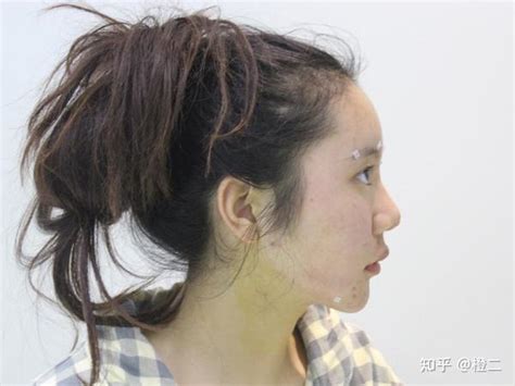 北京有专注吸脂 填充的医生吗价格贵不贵有哪些案例可参考呢 知乎