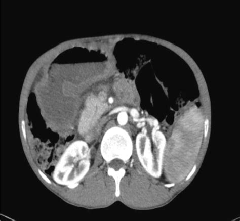 Abdominal Ct Scan With Contrast Showing Dilated Stomach And First Part Download Scientific