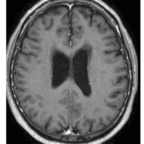 Csf Microscopy Showing One Medium ° And Four Smallsized Lymphoid